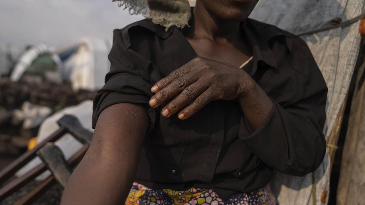 WHO declares mpox outbreak a global public health emergency - CGTN